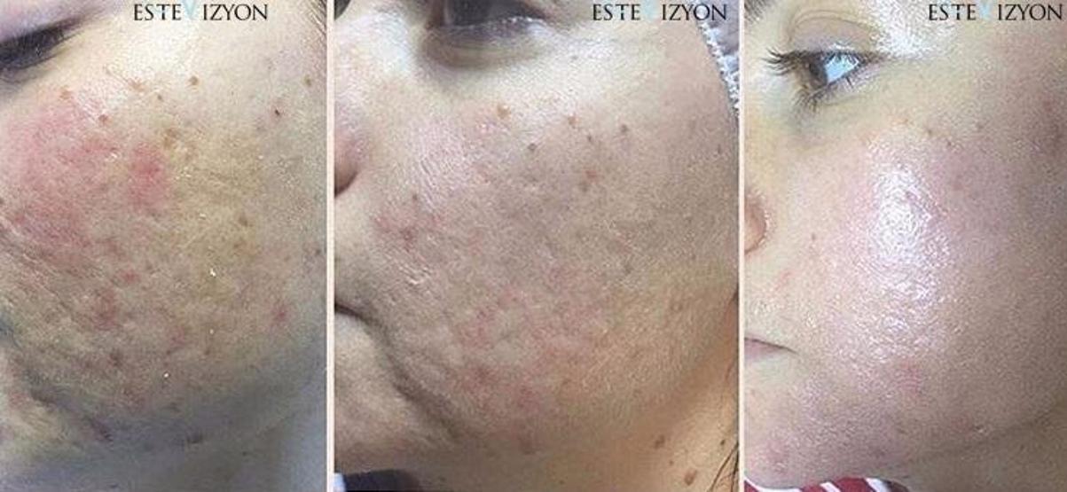 Kimyasal Peeling nedir? - Sağlık Haberleri