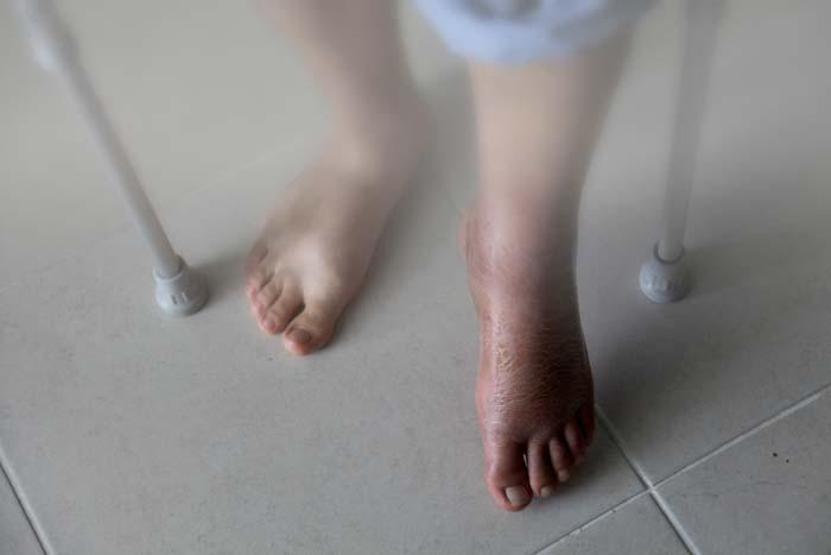 Fil Hastalığı yaşayanlara önemli uyarılar - Sağlık Haberleri