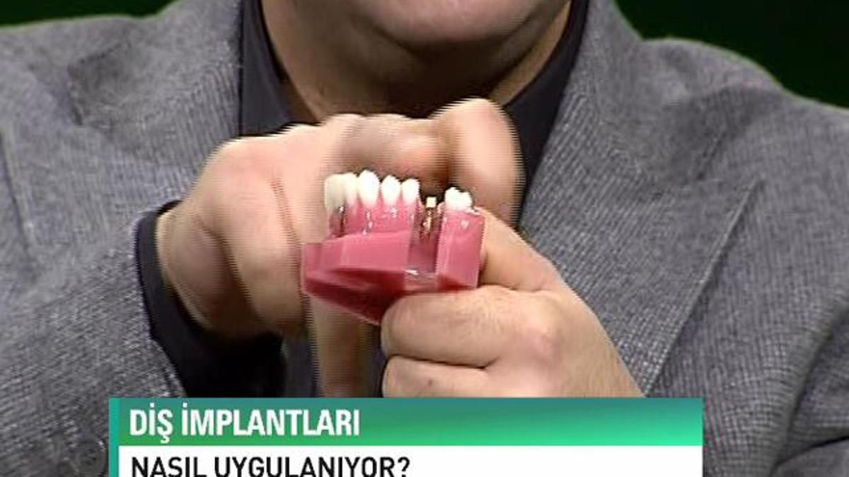 Diş implantları dişe nasıl uygulanır?