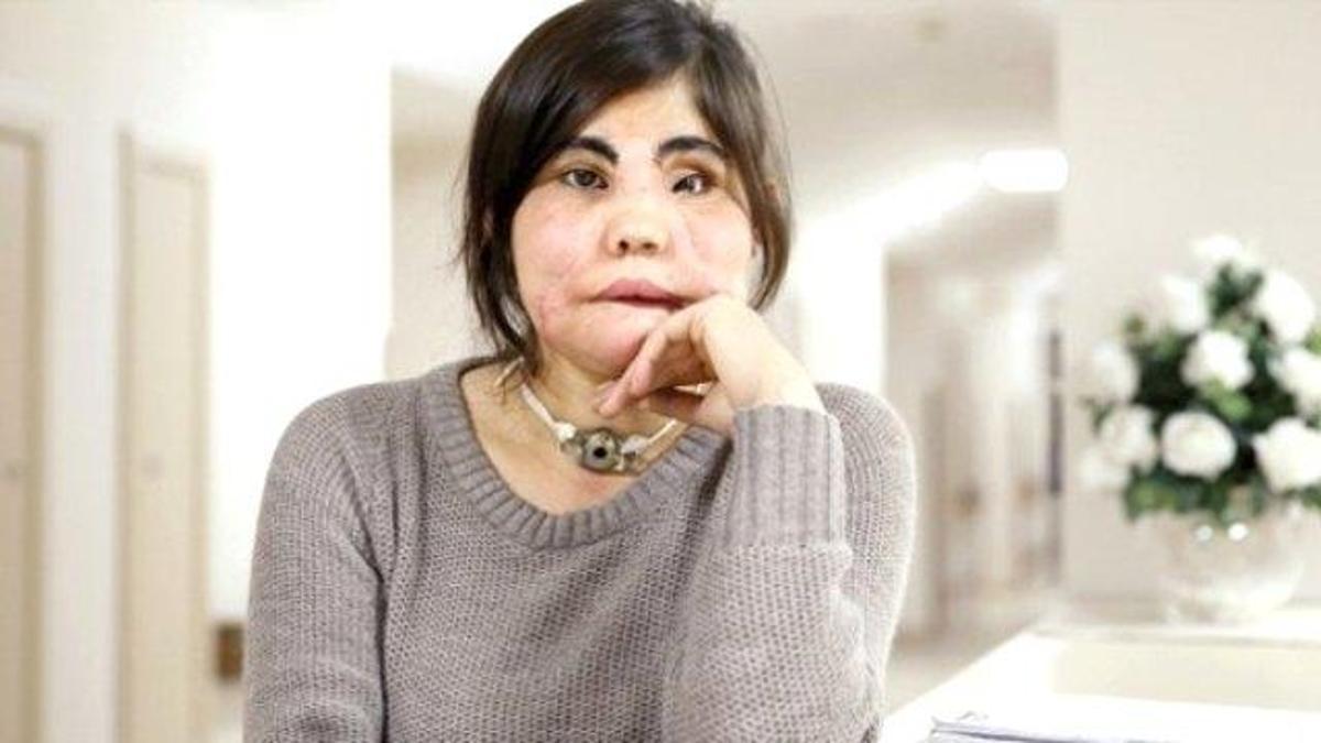 Türkiye'de yüz nakli olan ilk kadın hayatını kaybetti - CNN TÜRK Haberler