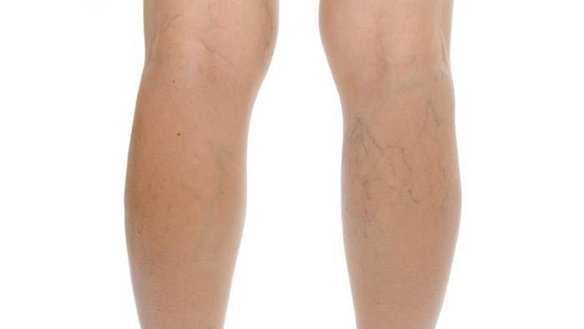 Varikosel nedir? Tedavisi nasıl olur? - Sağlık Haberleri