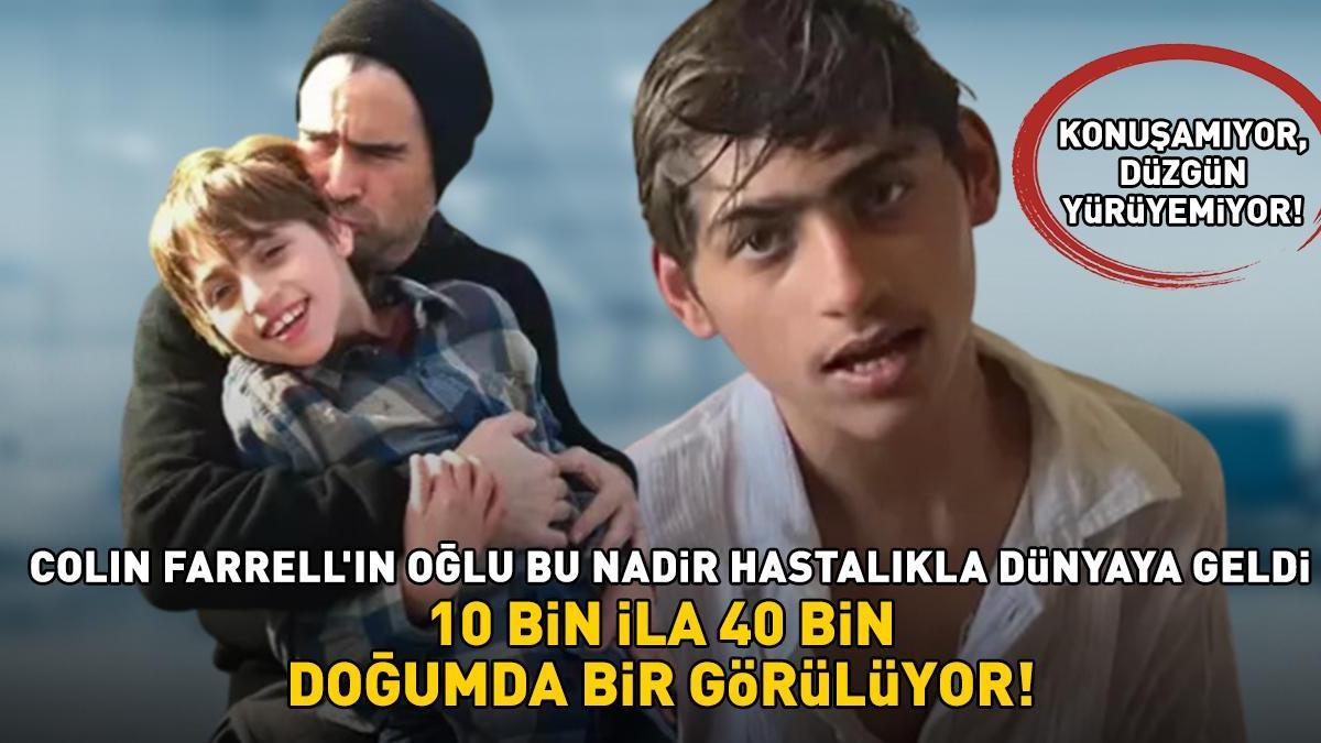 10 bin ila 40 bin doğumda bir görülüyor! Colin Farrell'ın oğlu da bu ...